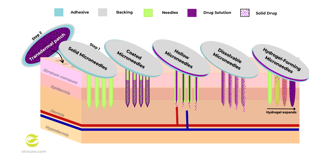 Microneedle Patches: Definition, Function, and Production
